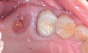 Pictures of Granulation Tissue After Tooth Extraction: Your Visual Guide to