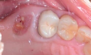 Pictures of Granulation Tissue After Tooth Extraction: Your Visual Guide to