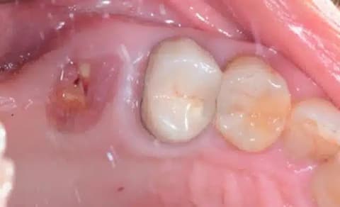 Pictures of Granulation Tissue After Tooth Extraction: Your Visual Guide to