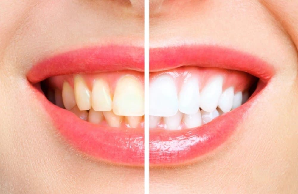 Palate Expander Before and After: With Pictures and What to Expect?